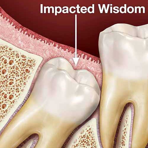 Impacted teeth treatment - Innovative Dental Specialist Center